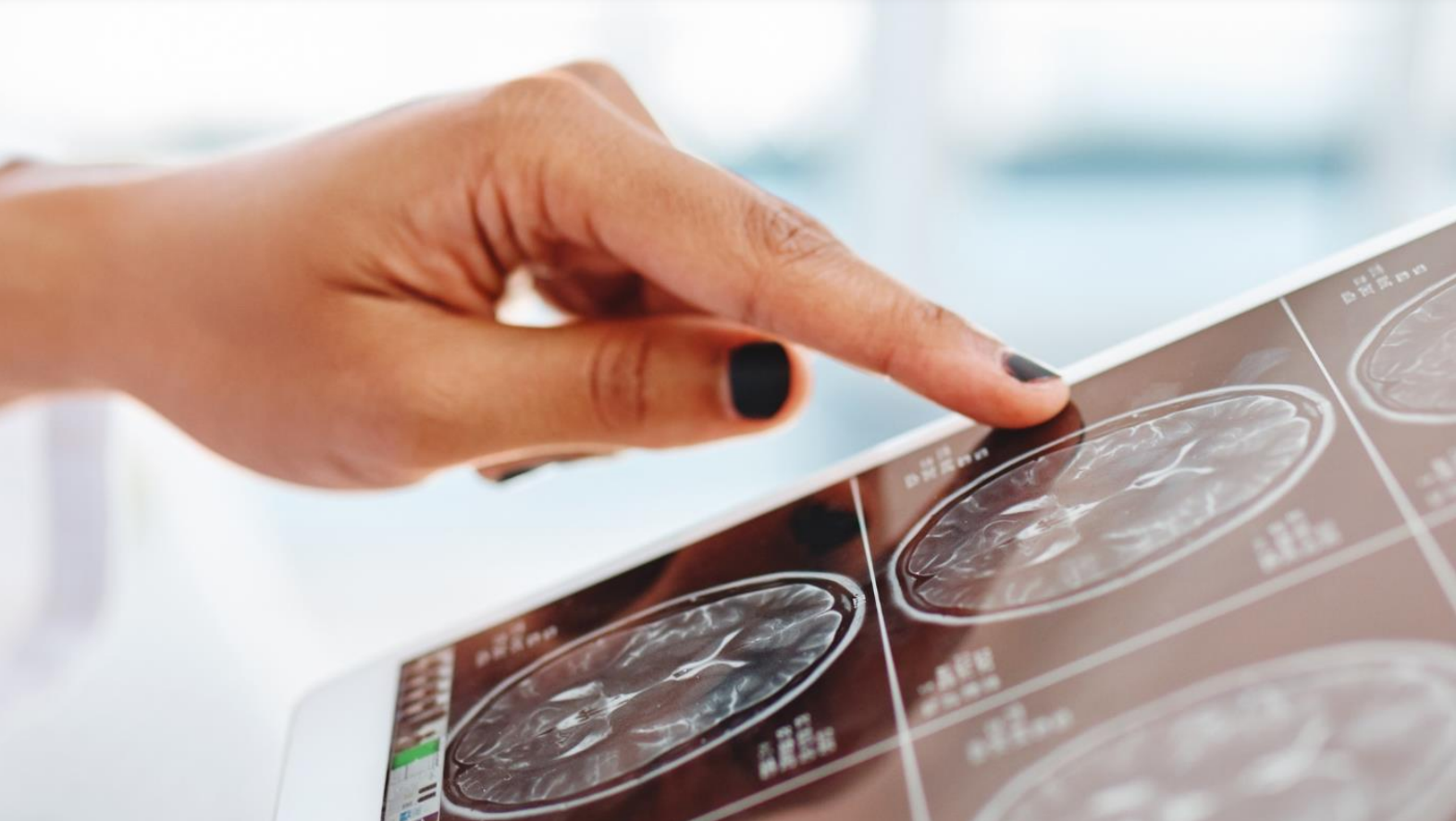 SBRI Healthcare Competition 18: Stroke and Technology - Innovate UK ...